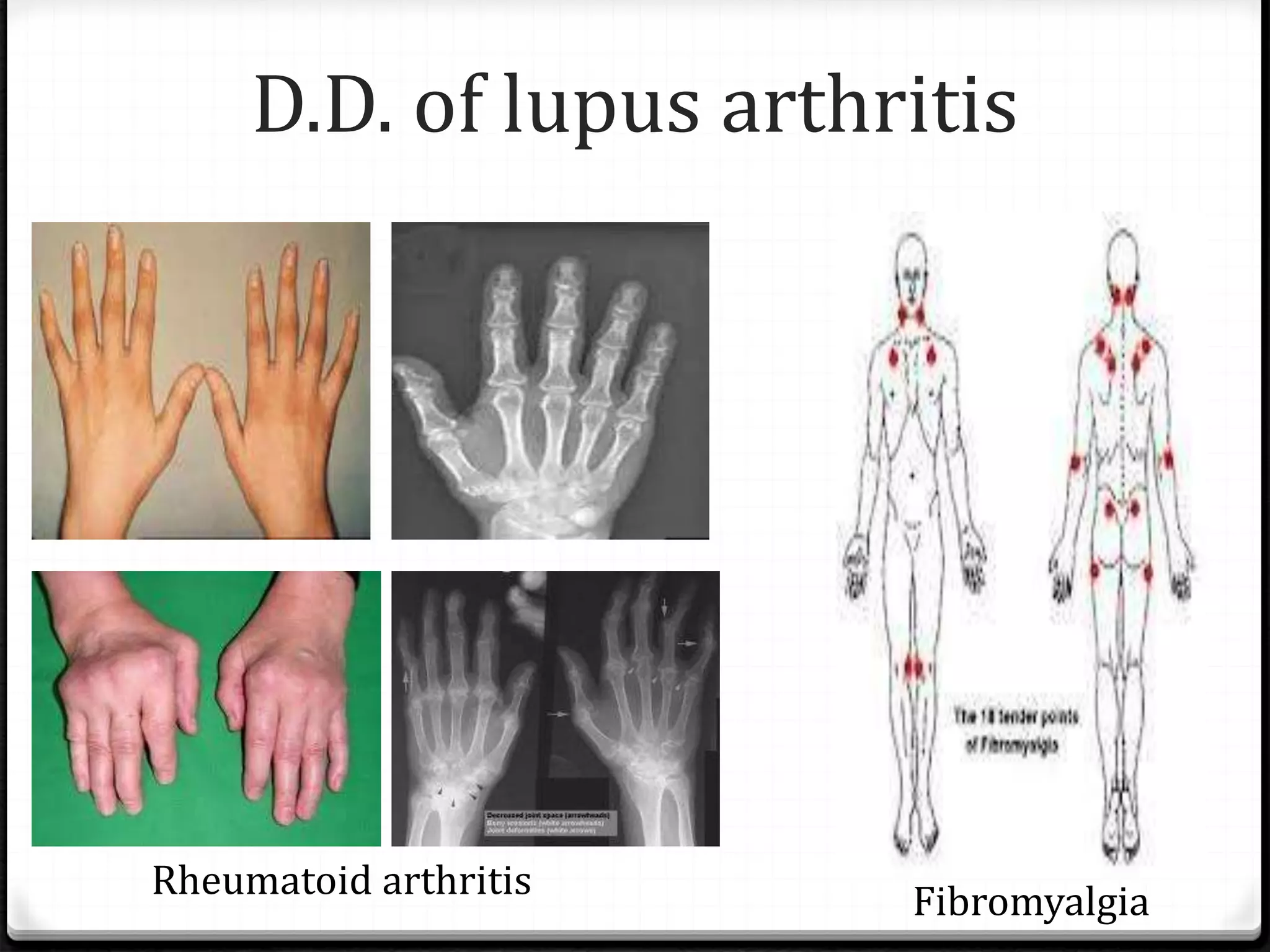 Clinical diagnosis of systemic lupus erythematosus | PDF