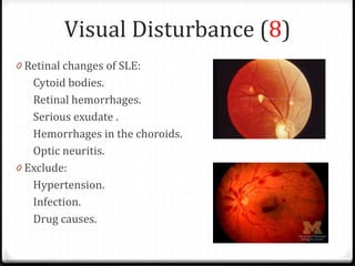 Clinical diagnosis of systemic lupus erythematosus | PDF