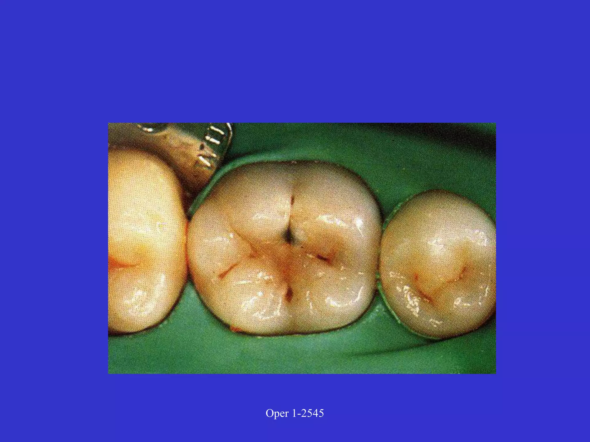 Clinical Diagnosis of Tooth Defects and Treatment Plan.ppt
