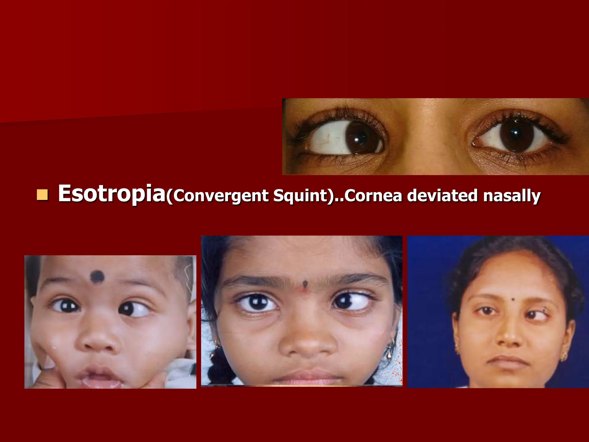 power point presentation of Clinical evaluation of strabismus | PPTX