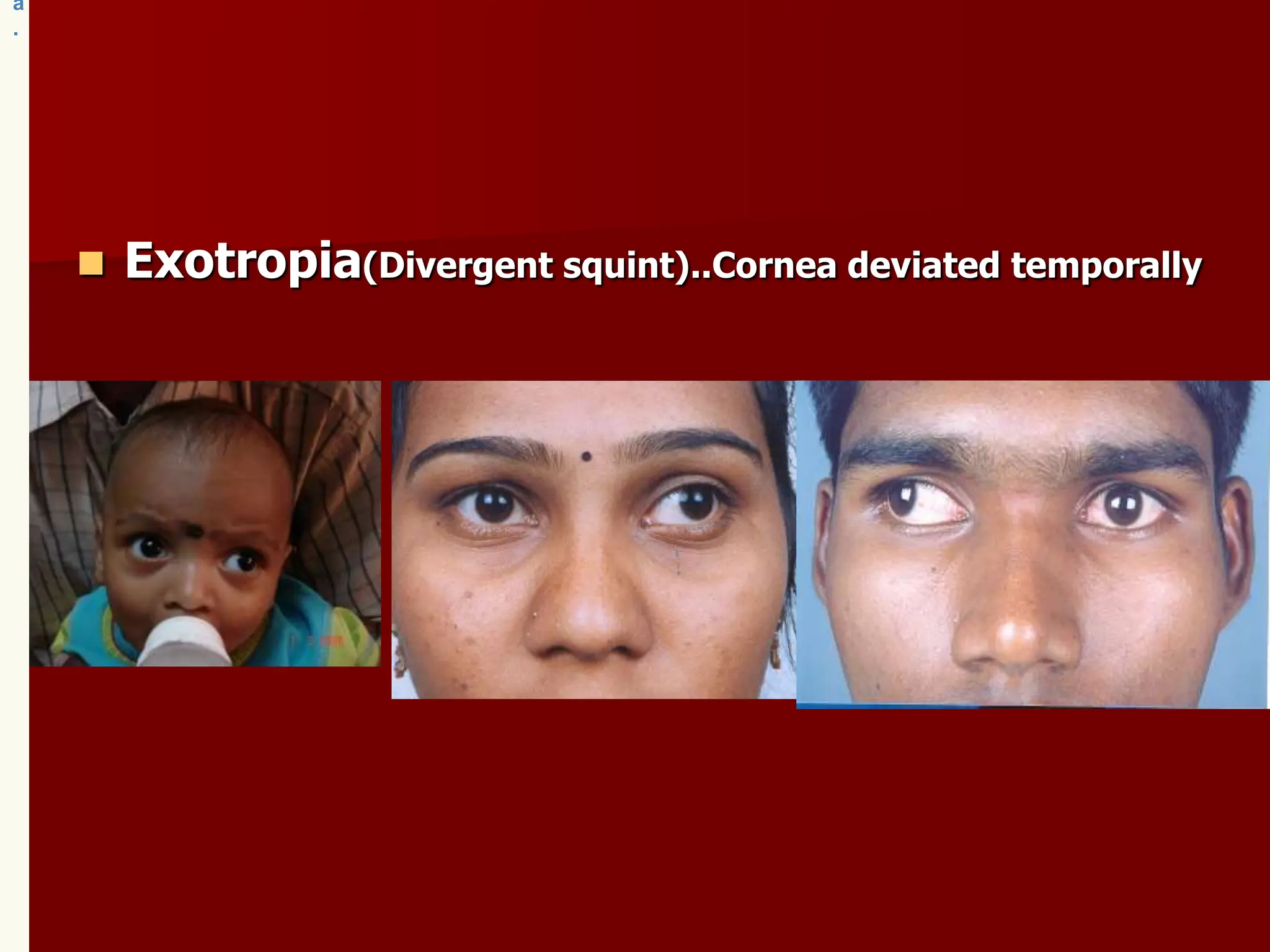 power point presentation of Clinical evaluation of strabismus | PPTX
