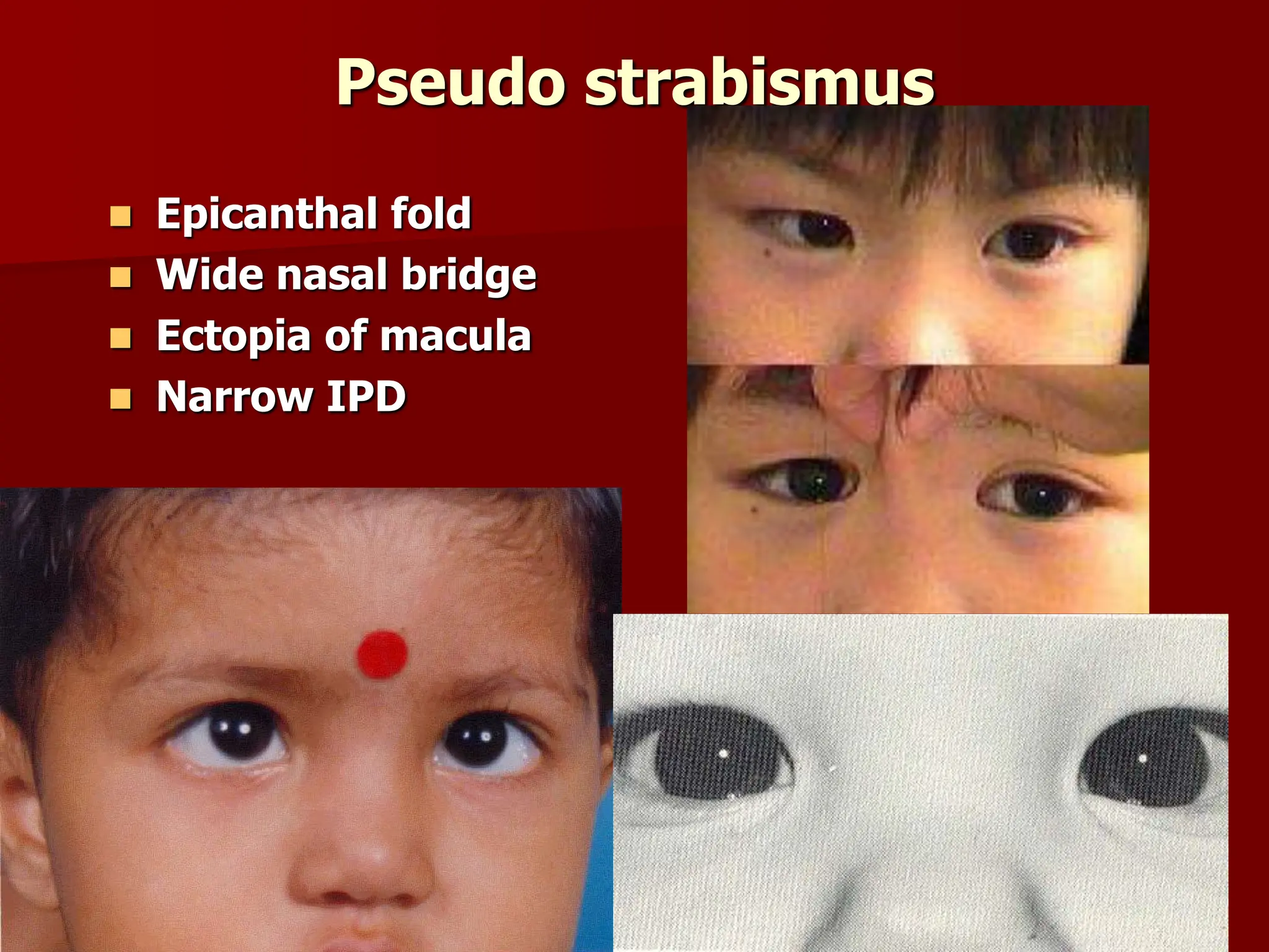 power point presentation of Clinical evaluation of strabismus | PPTX