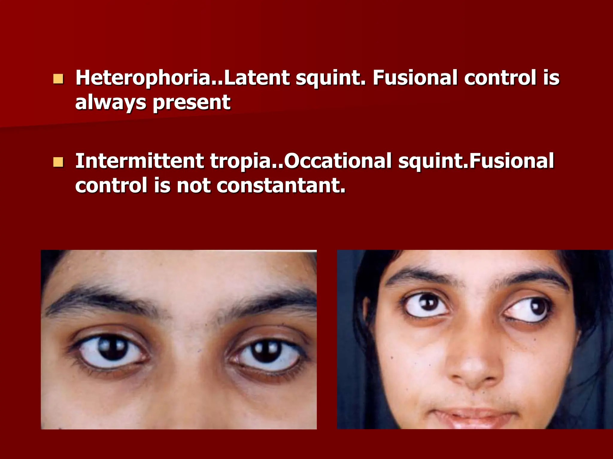 power point presentation of Clinical evaluation of strabismus | PPTX