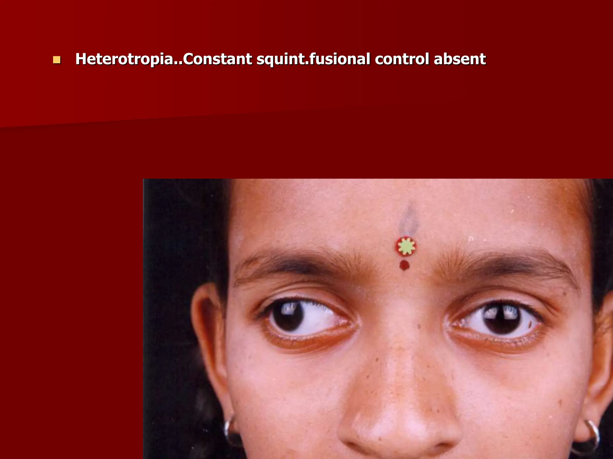 power point presentation of Clinical evaluation of strabismus | PPTX