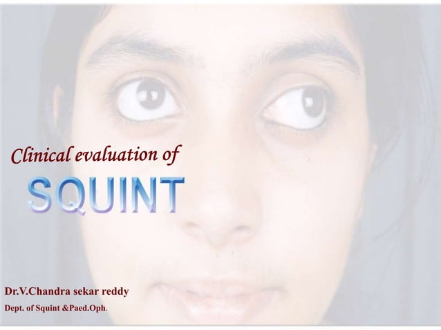 power point presentation of Clinical evaluation of strabismus | PPTX ...