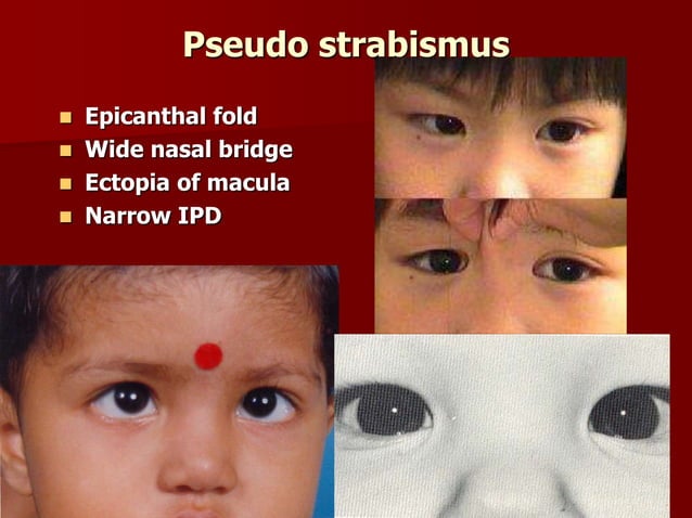 power point presentation of Clinical evaluation of strabismus | PPTX ...