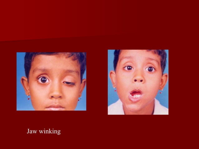 power point presentation of Clinical evaluation of strabismus | PPTX | Eye and Vision Conditions ...