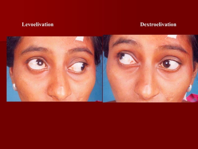 power point presentation of Clinical evaluation of strabismus | PPTX | Eye and Vision Conditions ...