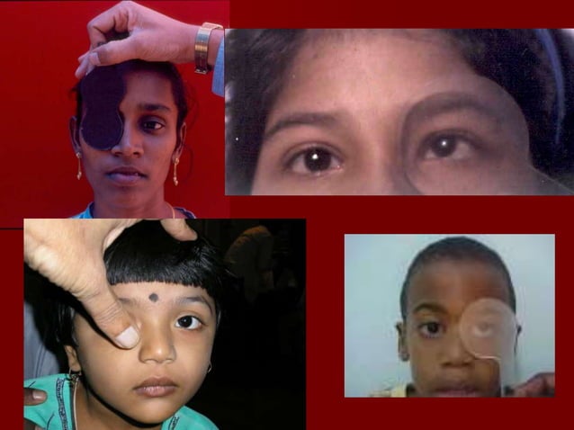 power point presentation of Clinical evaluation of strabismus | PPTX ...