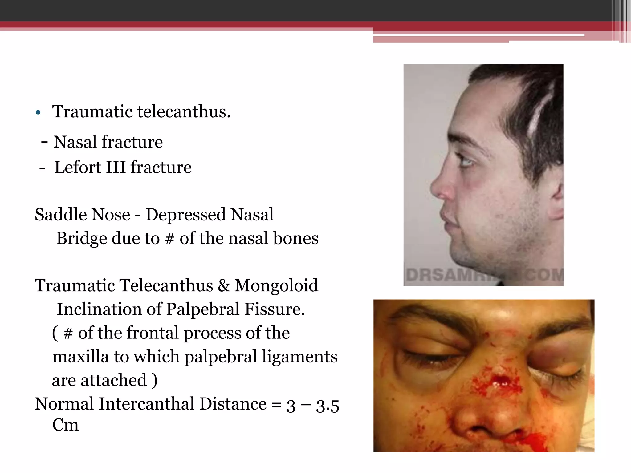 Clinical Evaluation in Maxillofacial Trauma | PPTX