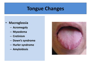 Macroglossia Acromegaly