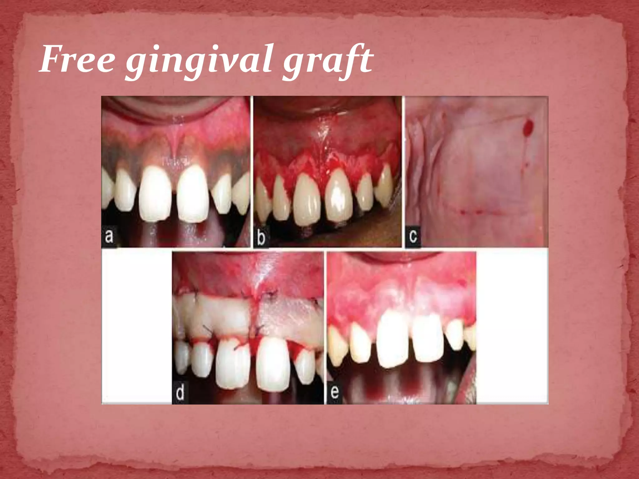 Clinical examination of gingiva | PPTX