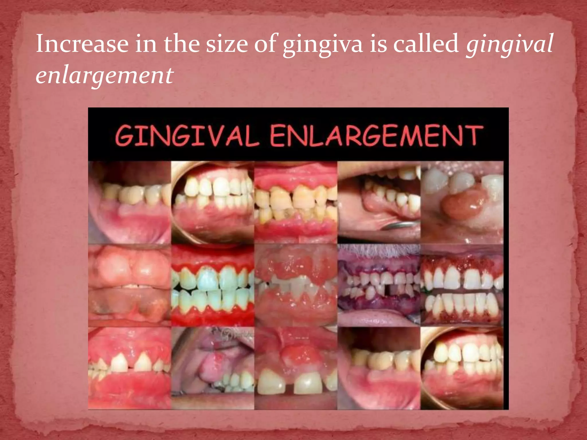Clinical examination of gingiva | PPTX