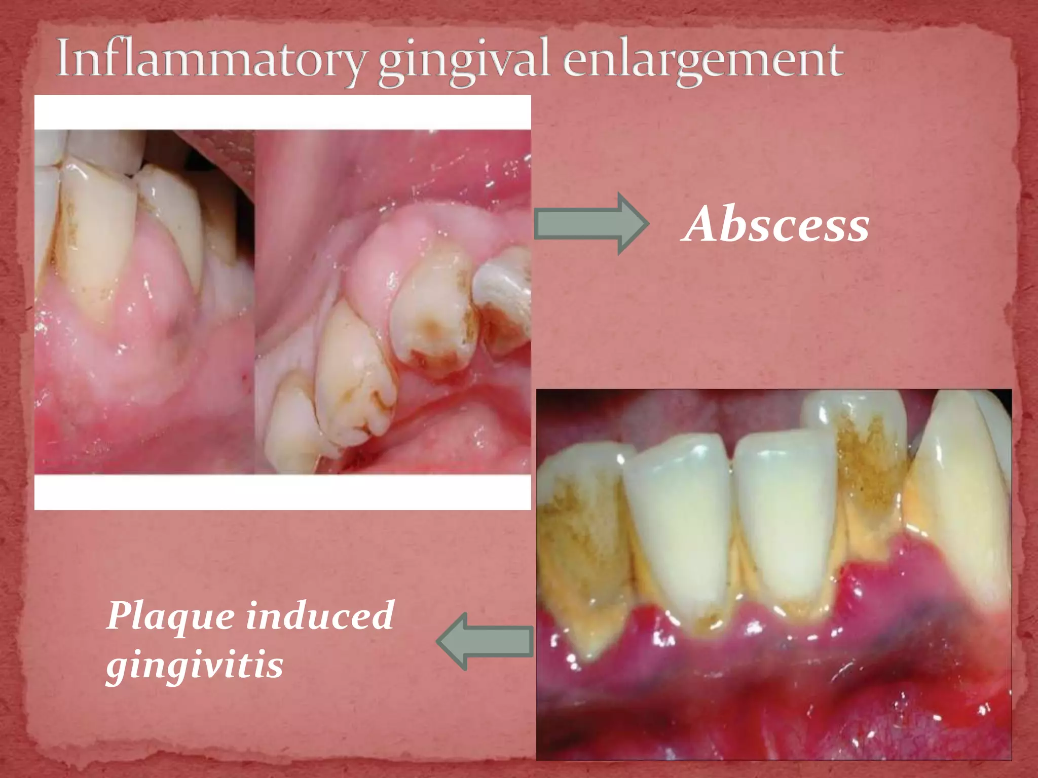 Clinical examination of gingiva | PPTX