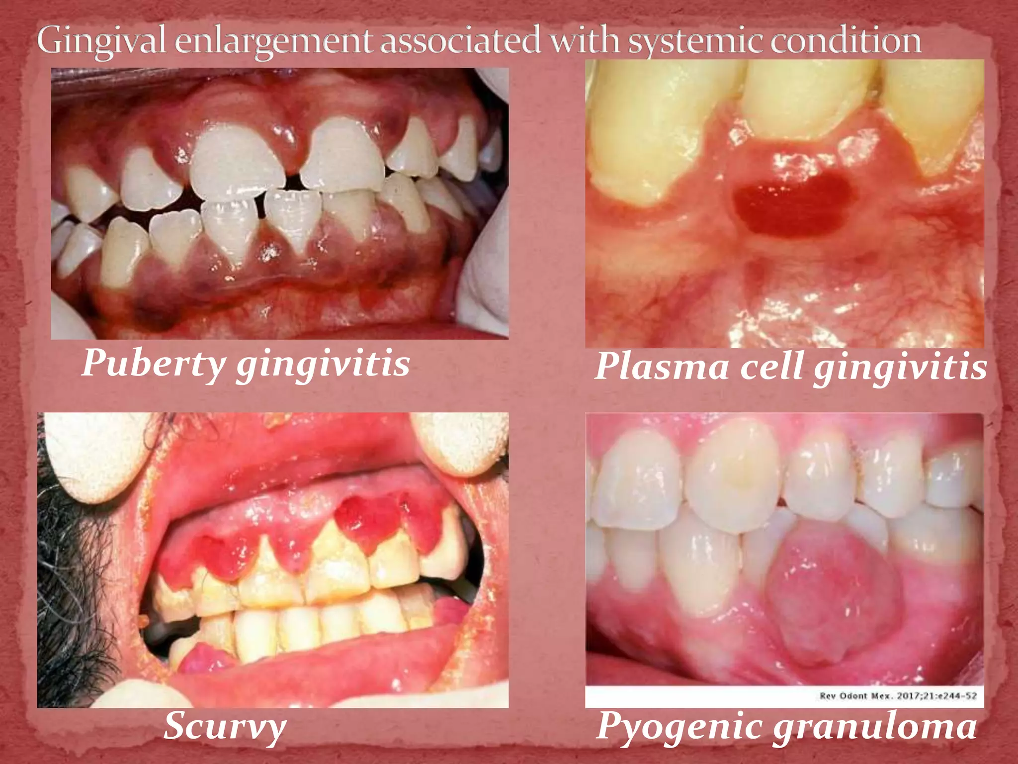 Clinical examination of gingiva | PPTX
