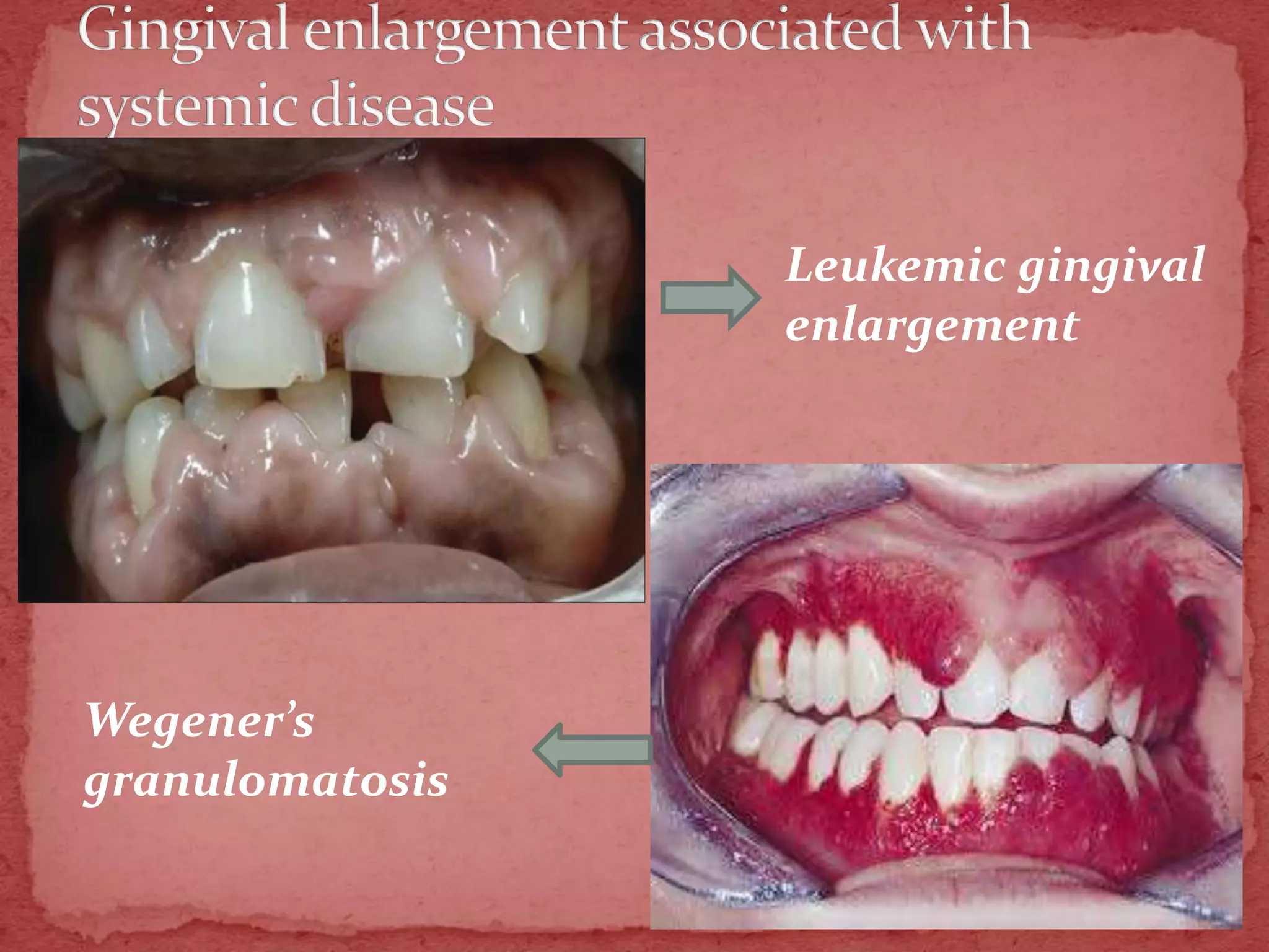Clinical examination of gingiva | PPTX