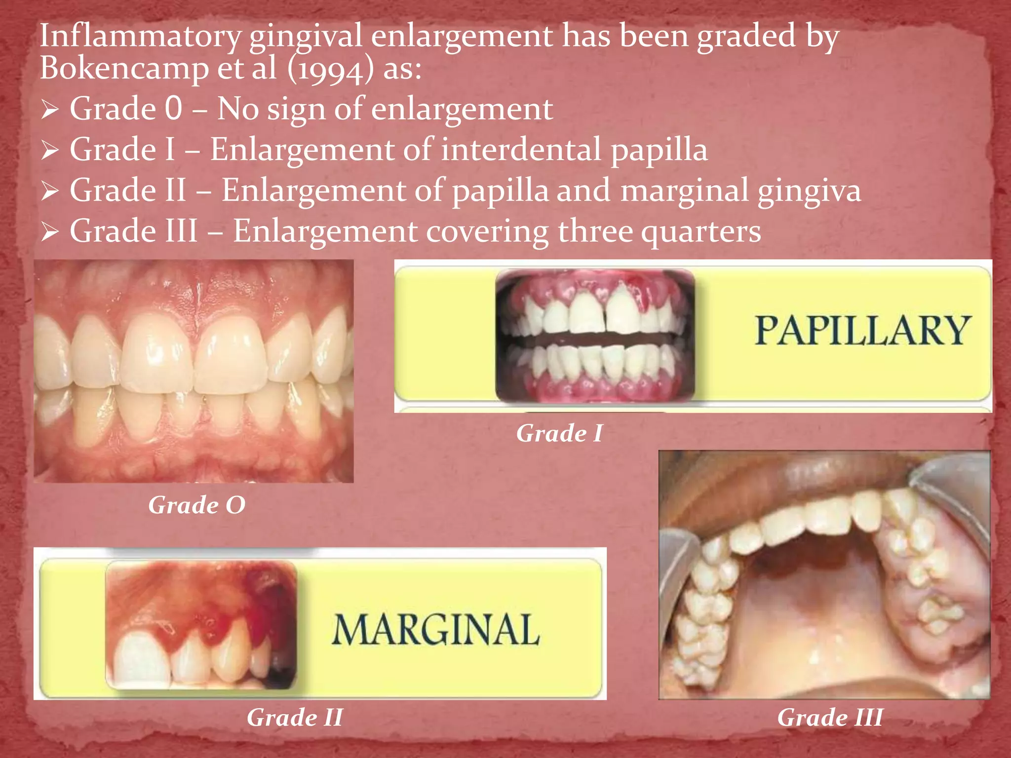 Clinical examination of gingiva | PPTX
