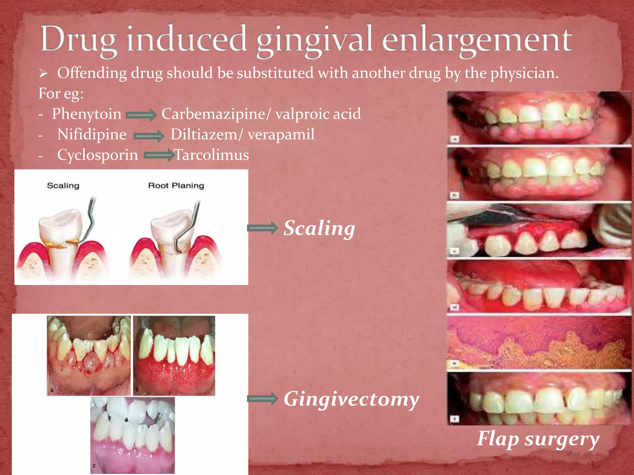 Clinical examination of gingiva | PPTX