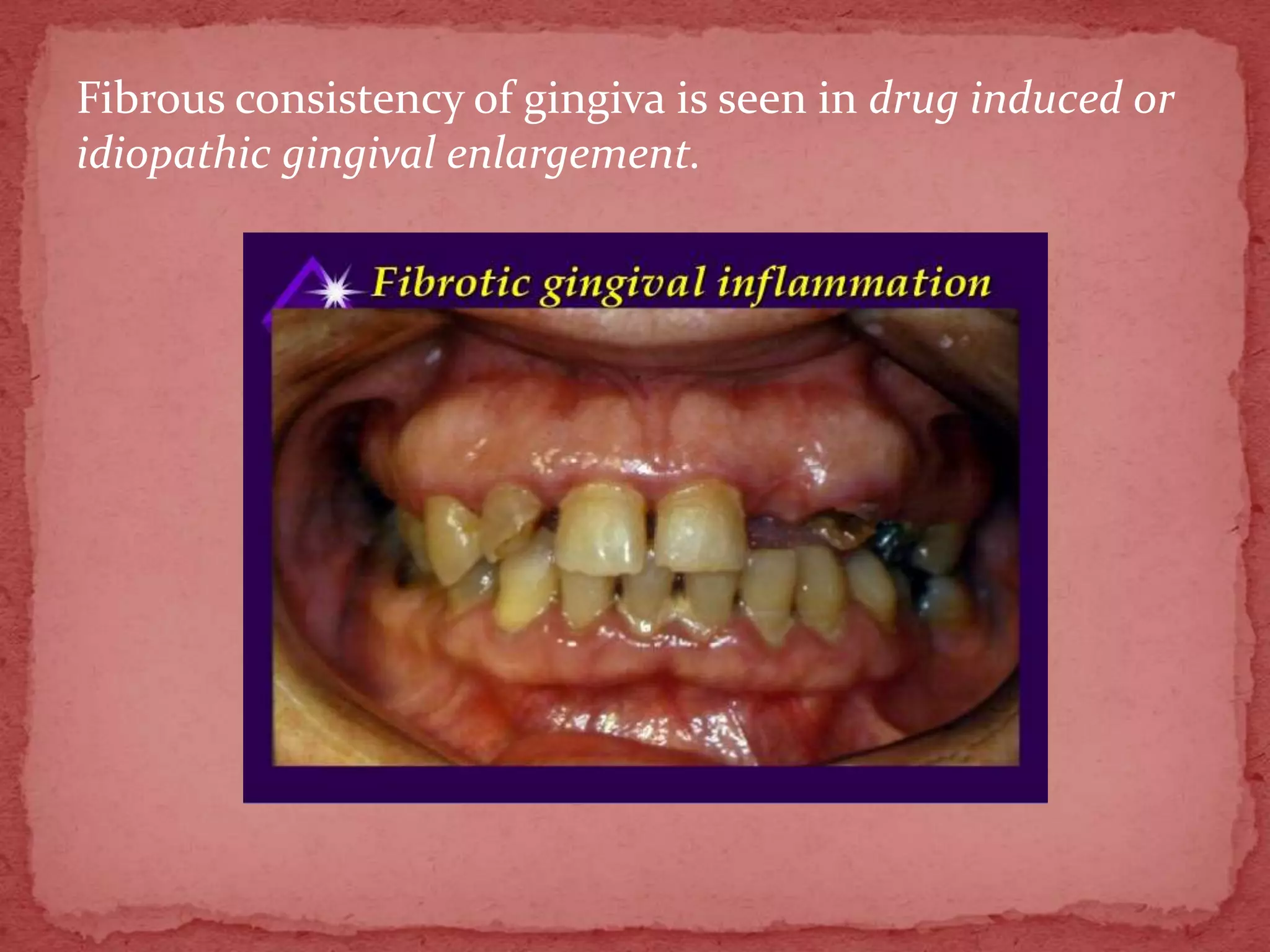 Clinical examination of gingiva | PPTX