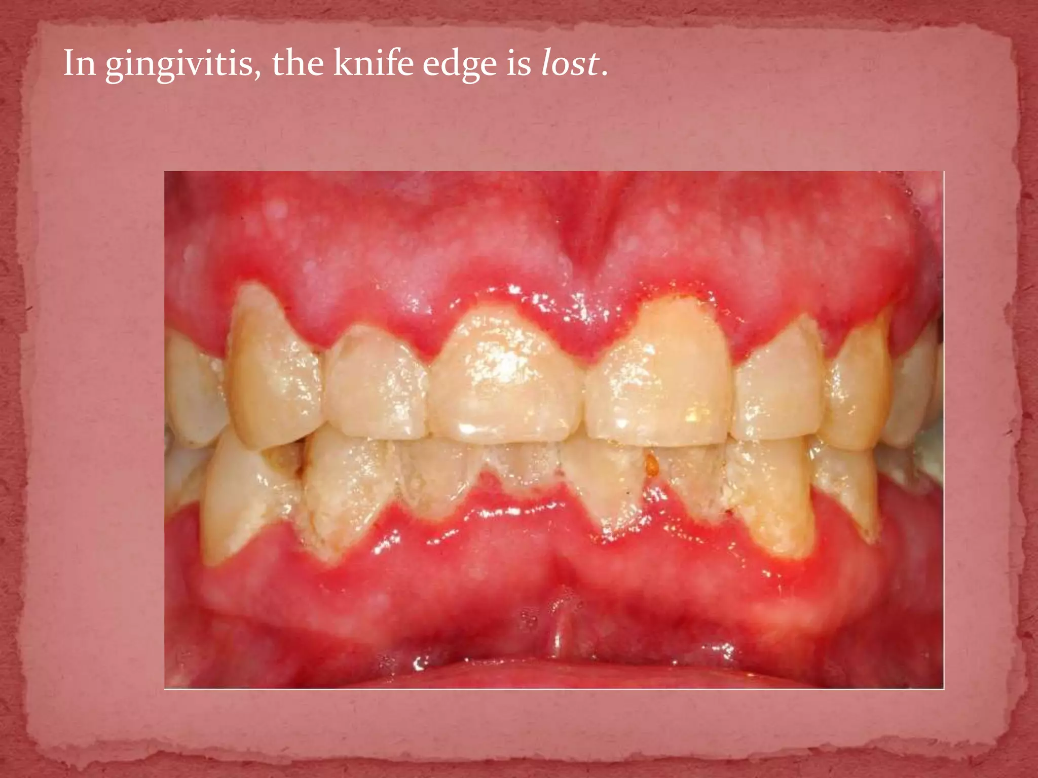 Clinical examination of gingiva | PPTX