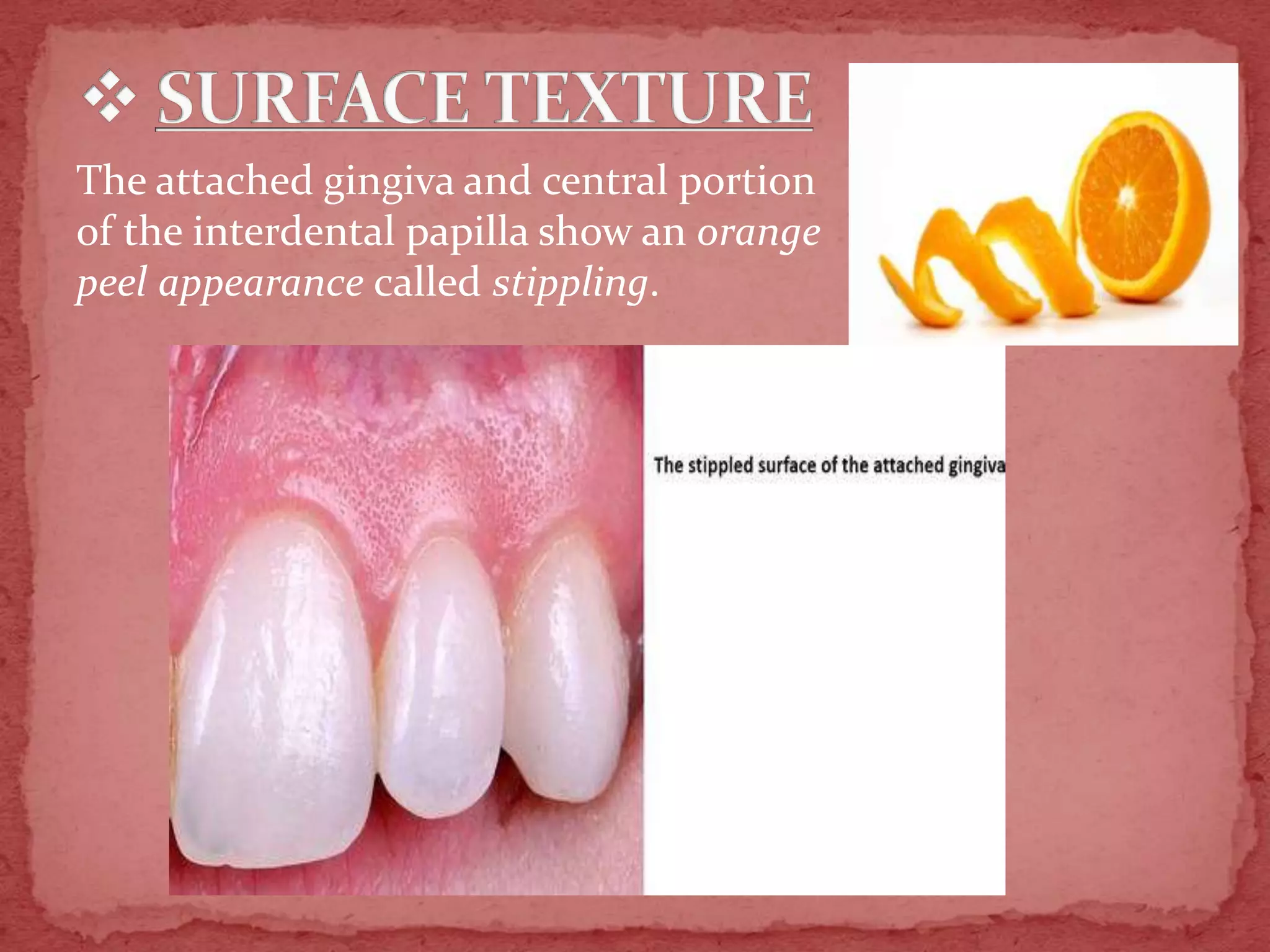 Clinical examination of gingiva | PPTX