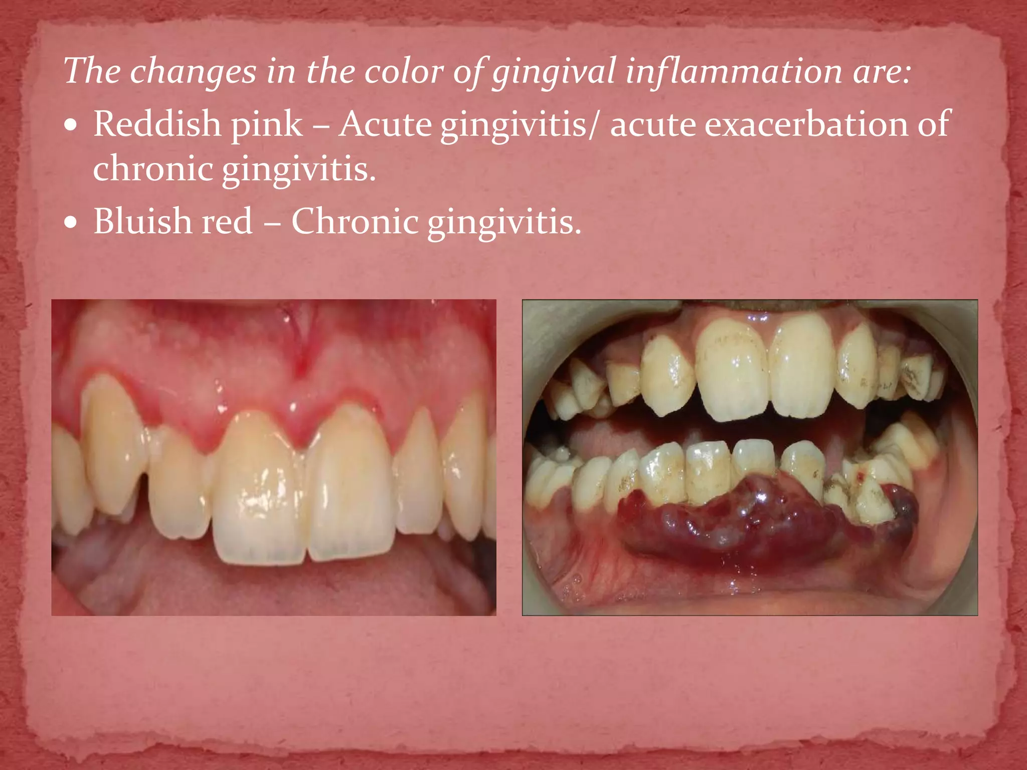 Clinical examination of gingiva | PPTX