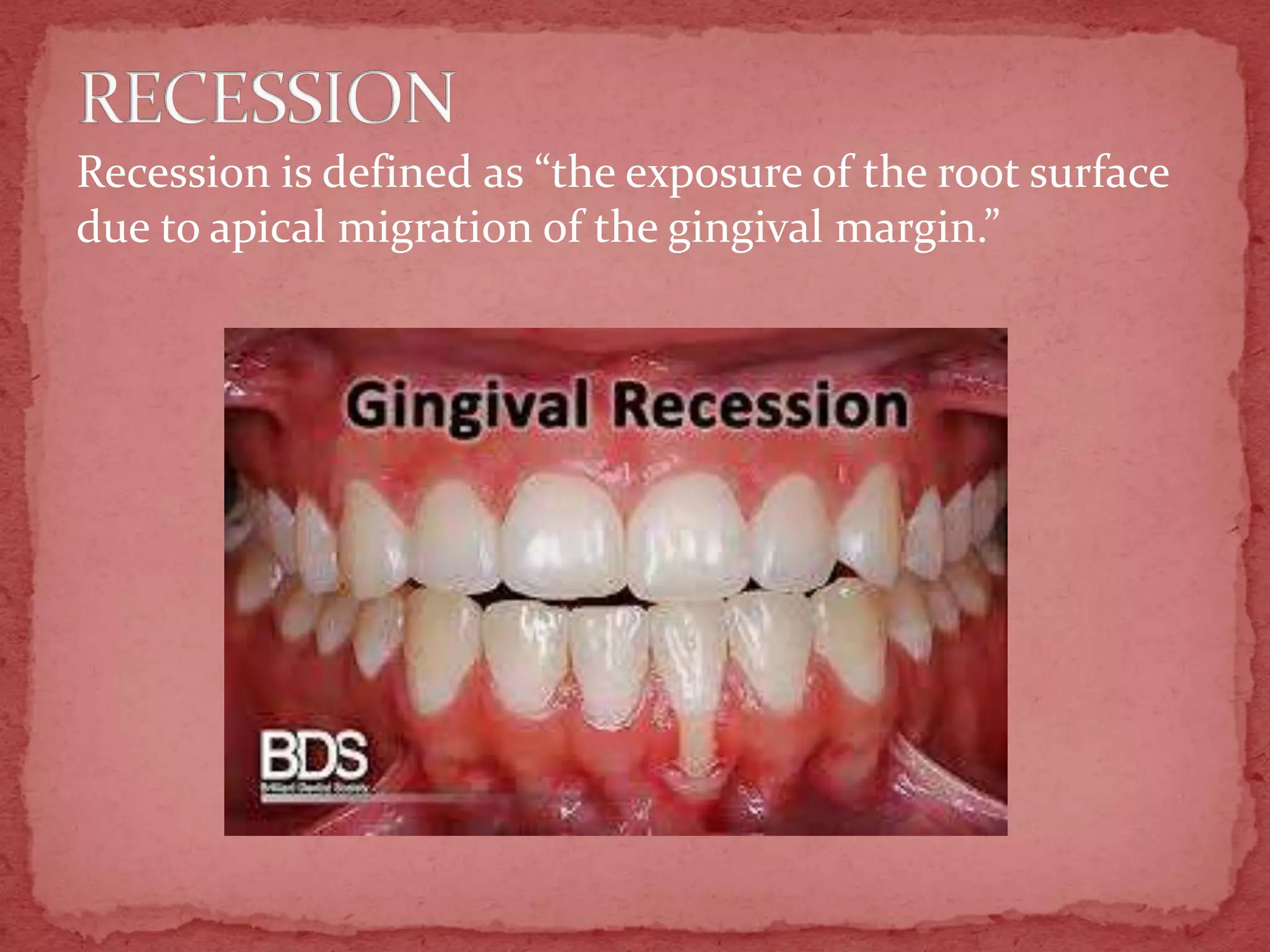 Clinical examination of gingiva | PPTX