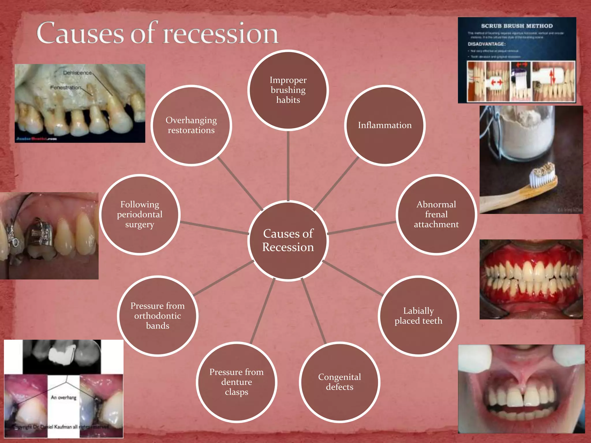 Clinical examination of gingiva | PPTX