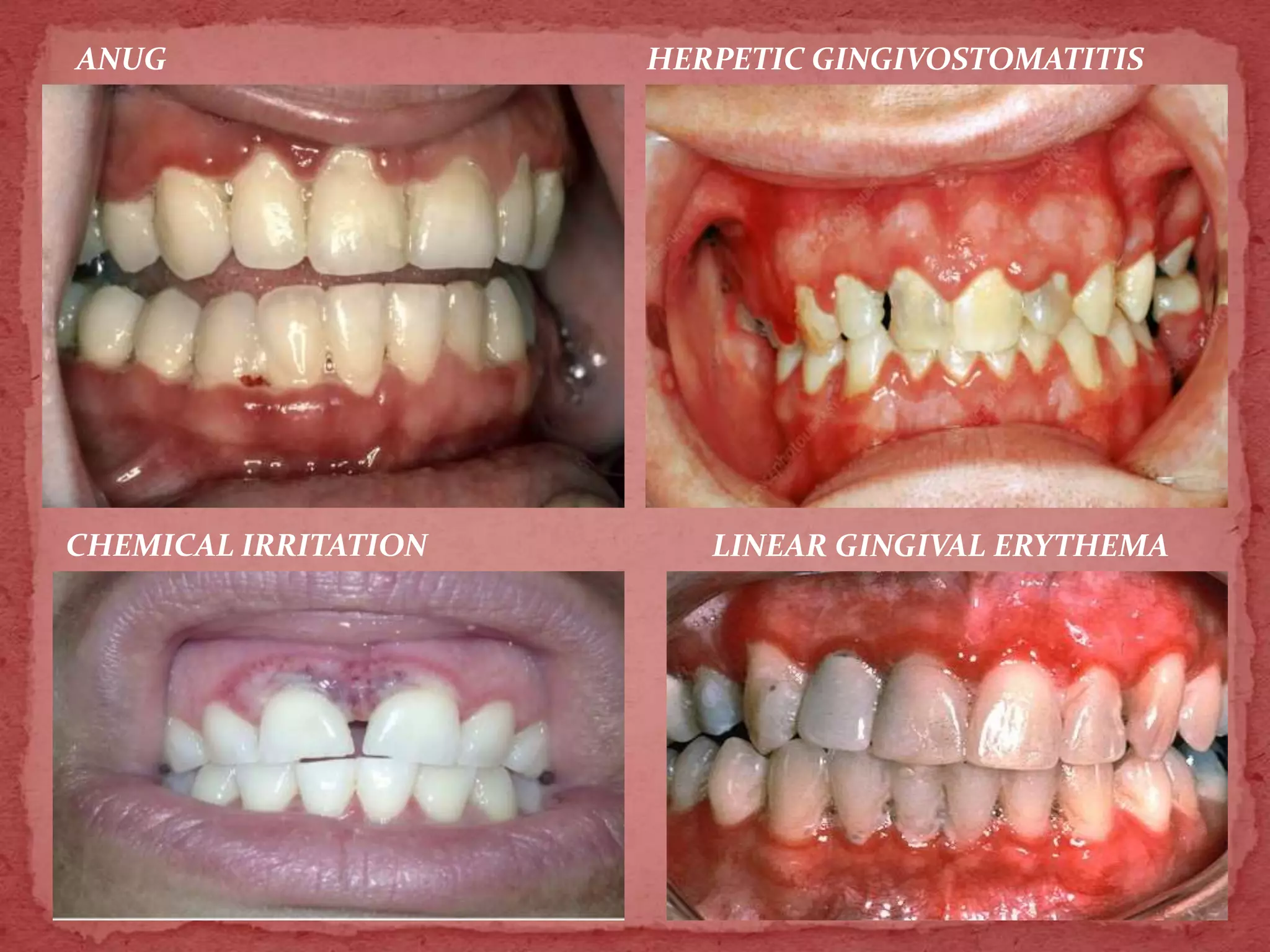 Clinical examination of gingiva | PPTX