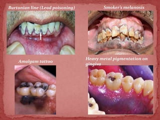 Clinical examination of gingiva | PPTX
