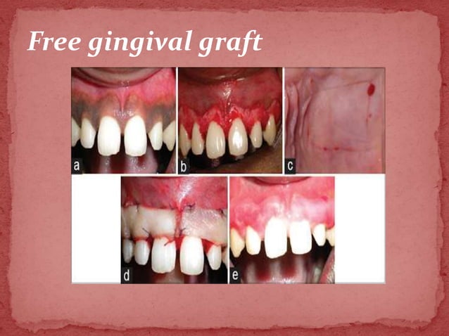 Clinical examination of gingiva | PPTX | Oral care | Personal Care
