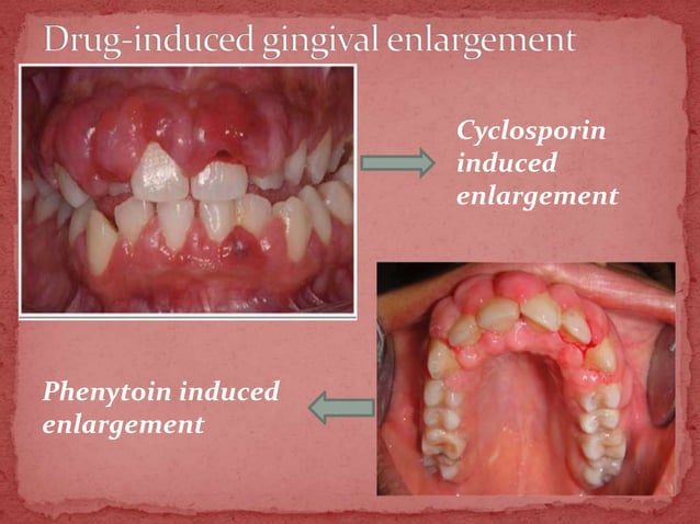 Clinical examination of gingiva | PPTX | Oral care | Personal Care