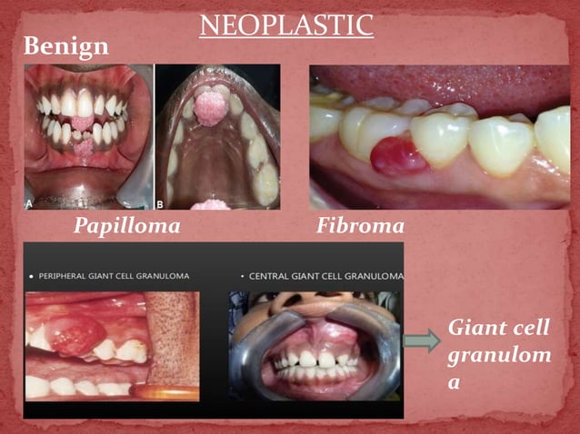 Clinical examination of gingiva | PPTX | Oral care | Personal Care
