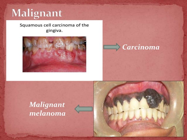 Clinical examination of gingiva | PPTX | Oral care | Personal Care
