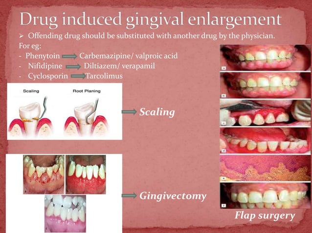 Clinical examination of gingiva | PPTX | Oral care | Personal Care