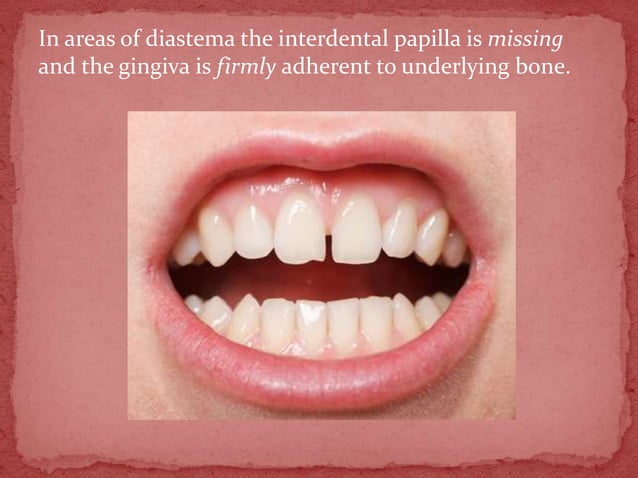 Clinical examination of gingiva | PPTX | Oral care | Personal Care