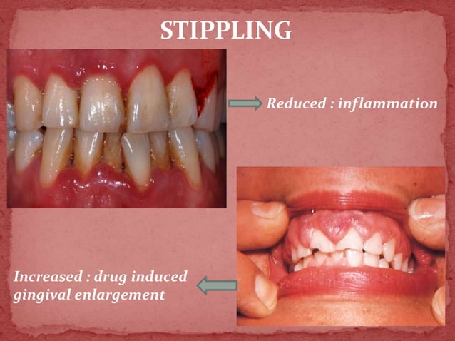 Clinical examination of gingiva | PPTX | Oral care | Personal Care