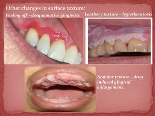 Clinical examination of gingiva | PPTX
