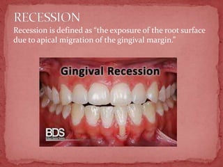 Clinical examination of gingiva | PPTX
