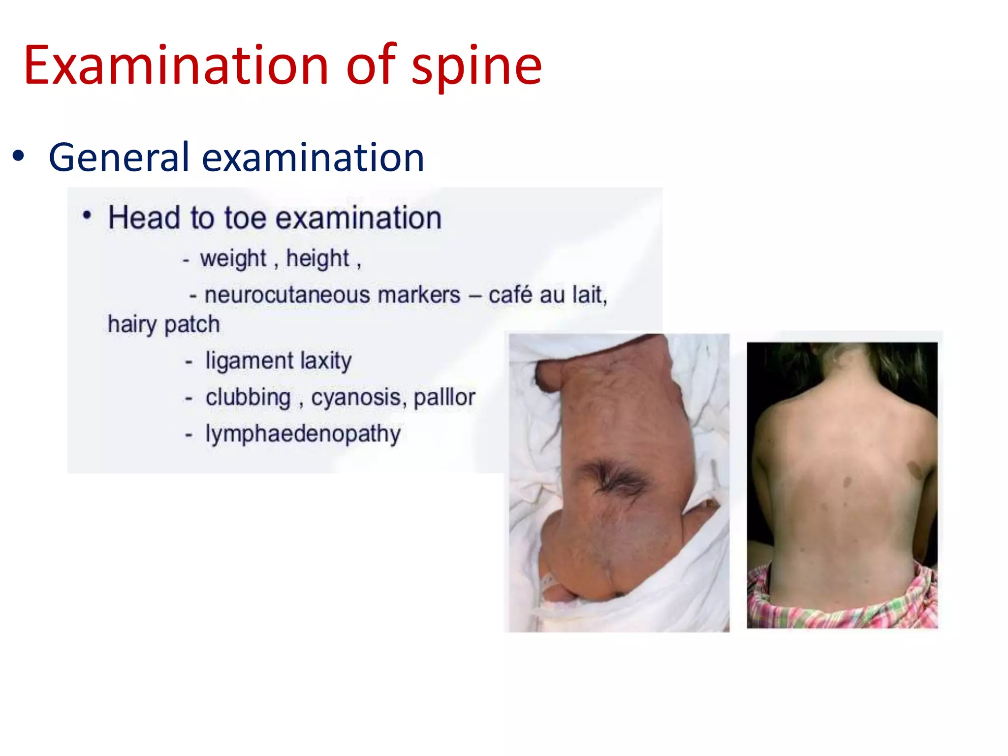 Clinical examination of spine | PPT
