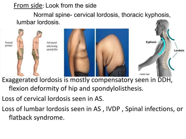 Clinical examination of spine | PPT