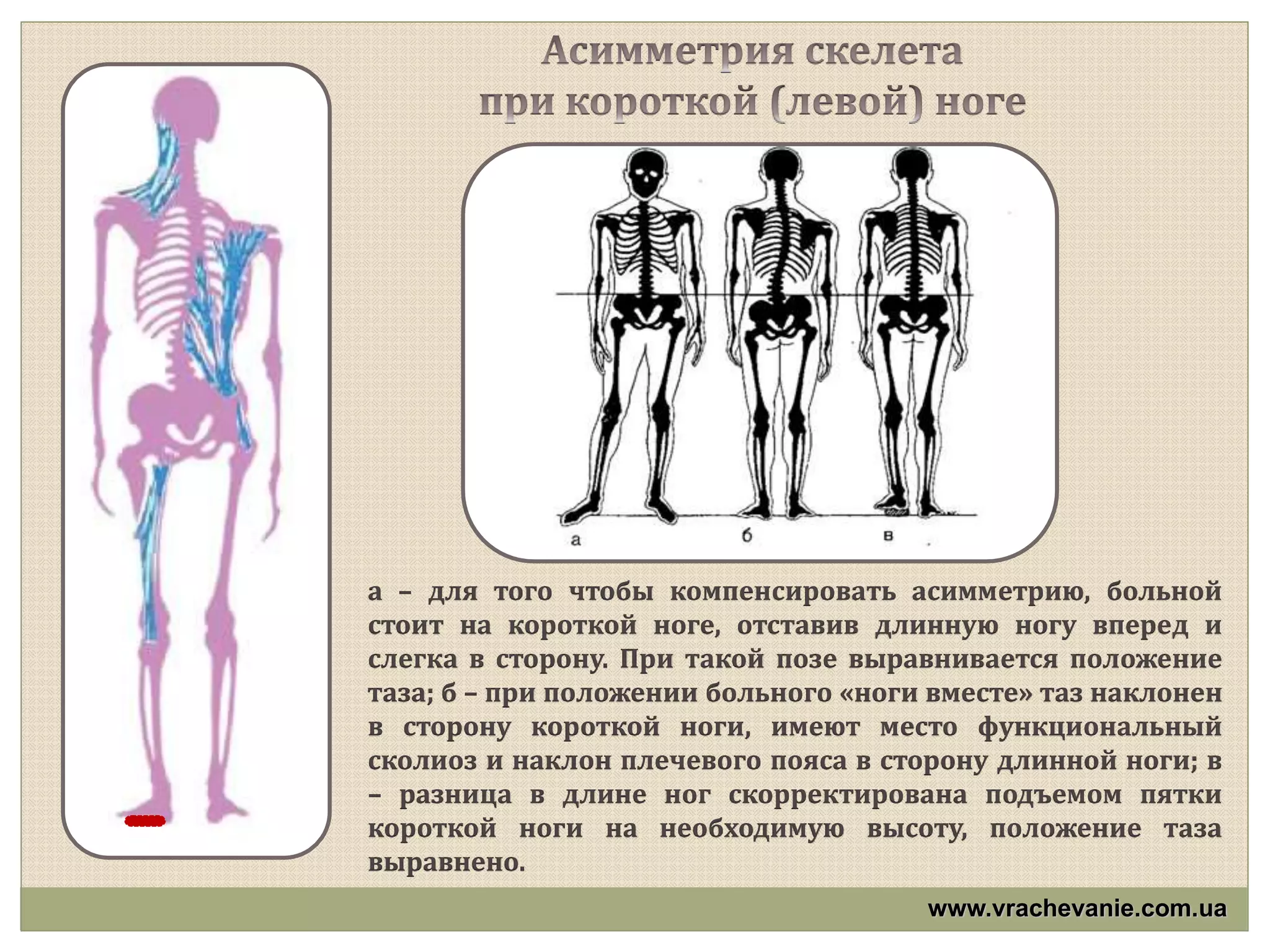 clinical_example_impaired_posture_pps_np | PPT