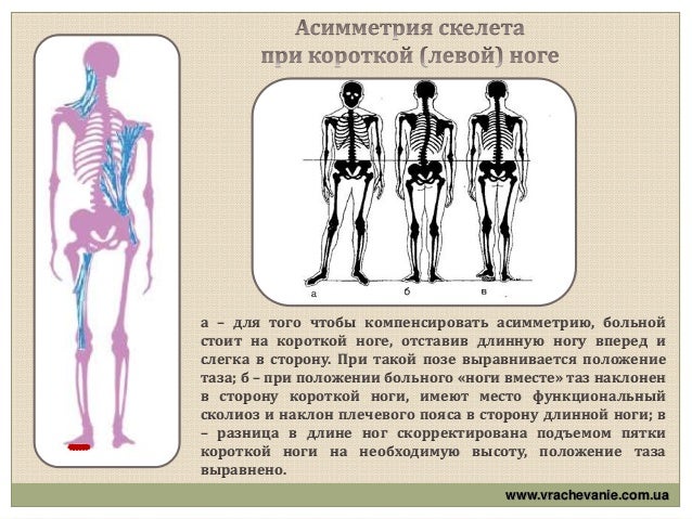 clinical_example_impaired_posture_pps_np