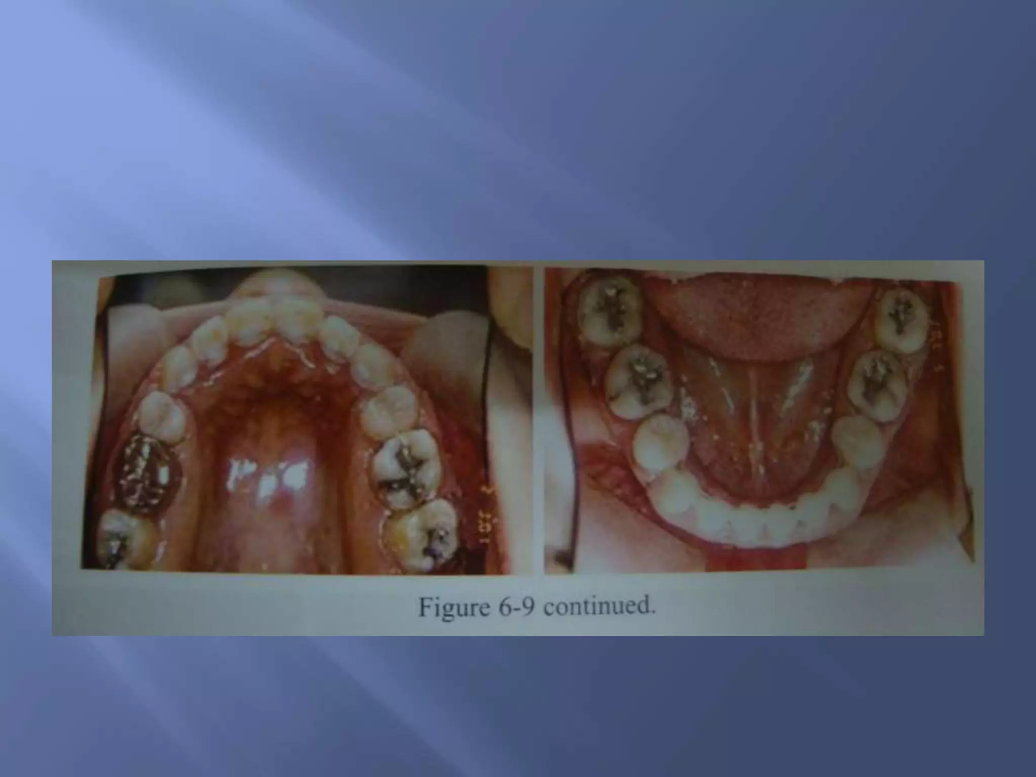 Clinical examples of microimplant anchorage | PPTX
