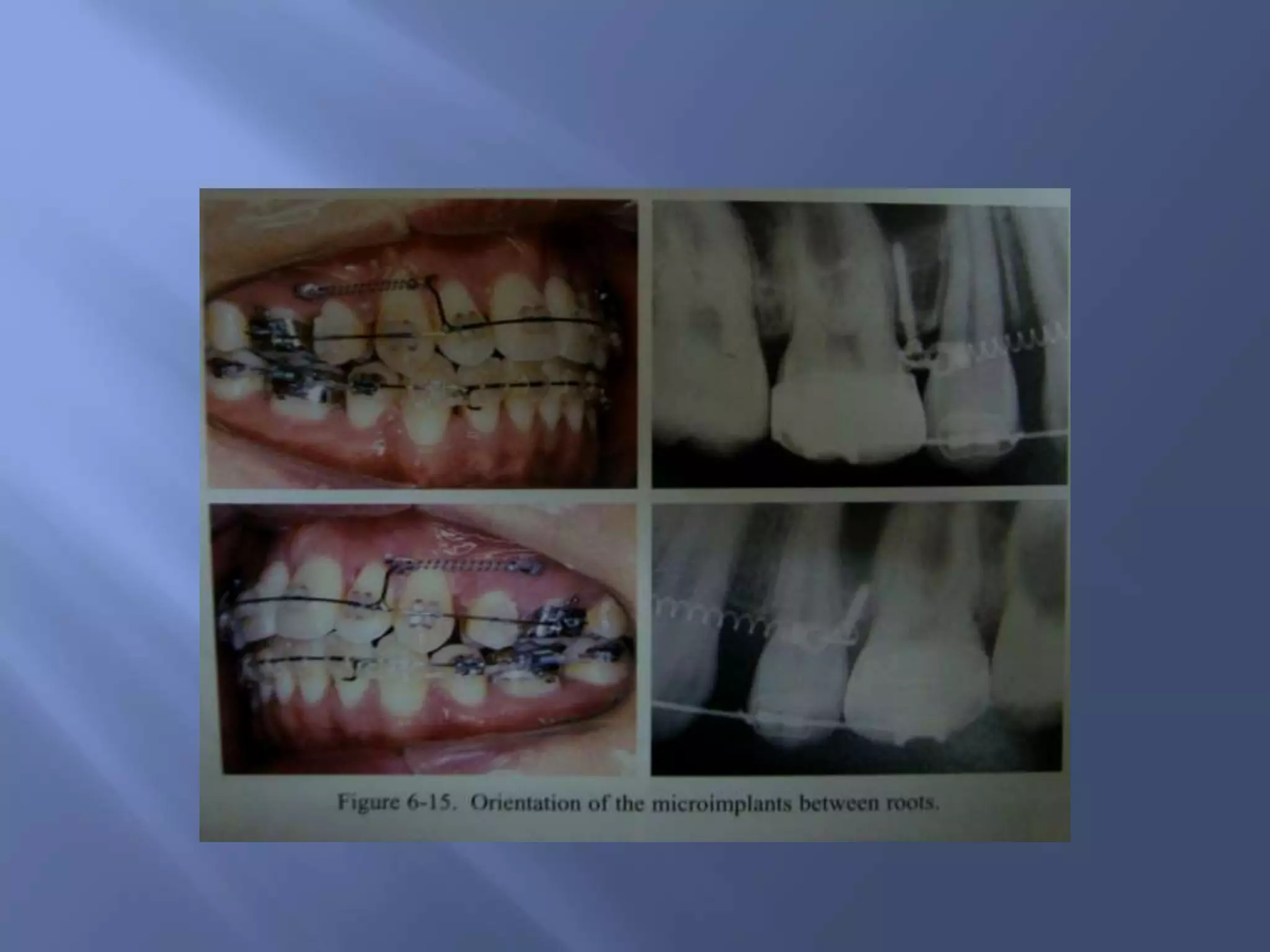 Clinical examples of microimplant anchorage | PPTX