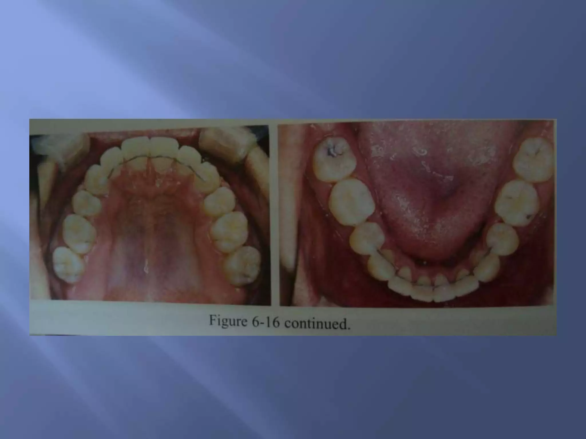 Clinical examples of microimplant anchorage | PPTX