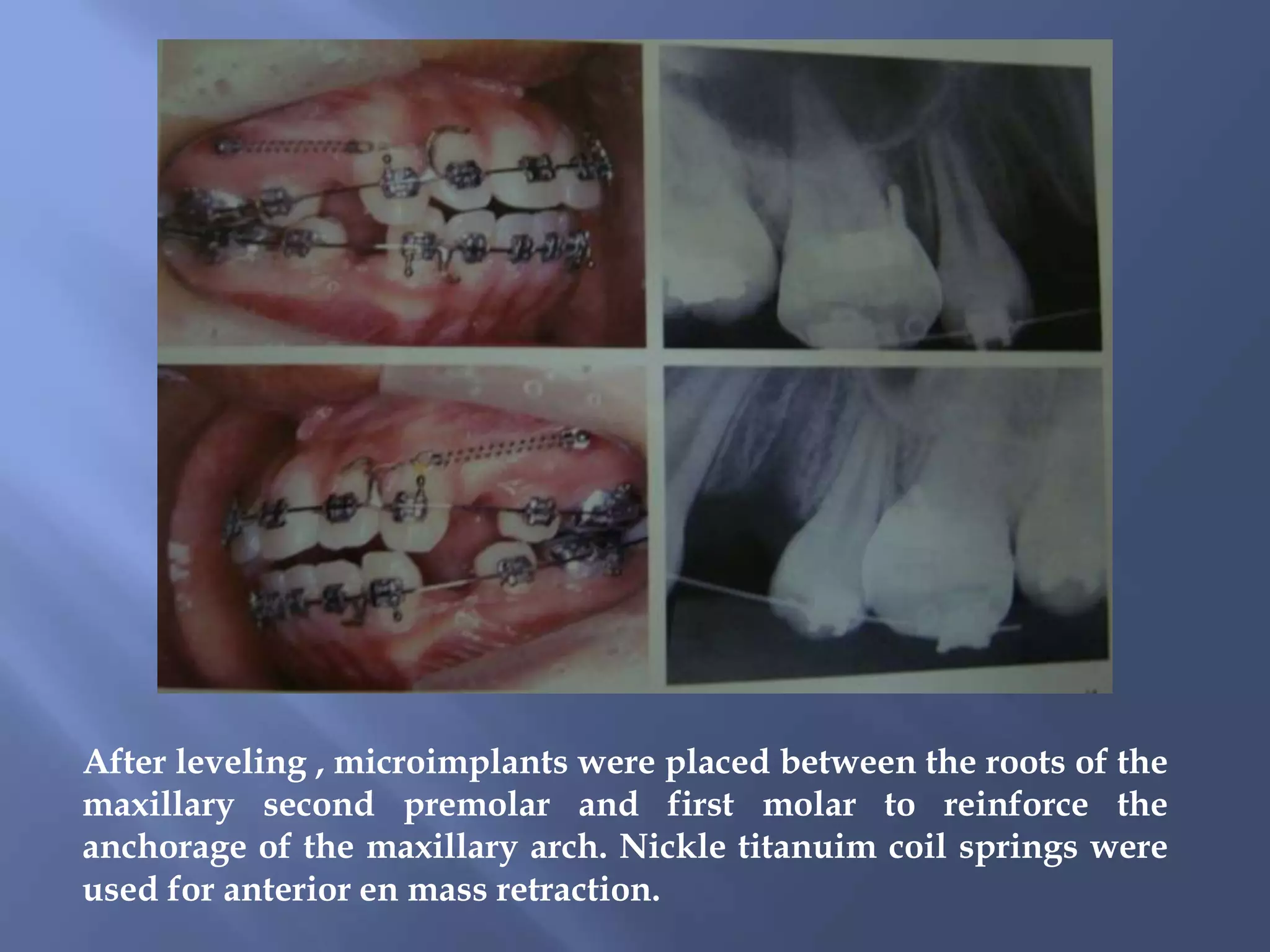 Clinical examples of microimplant anchorage | PPTX