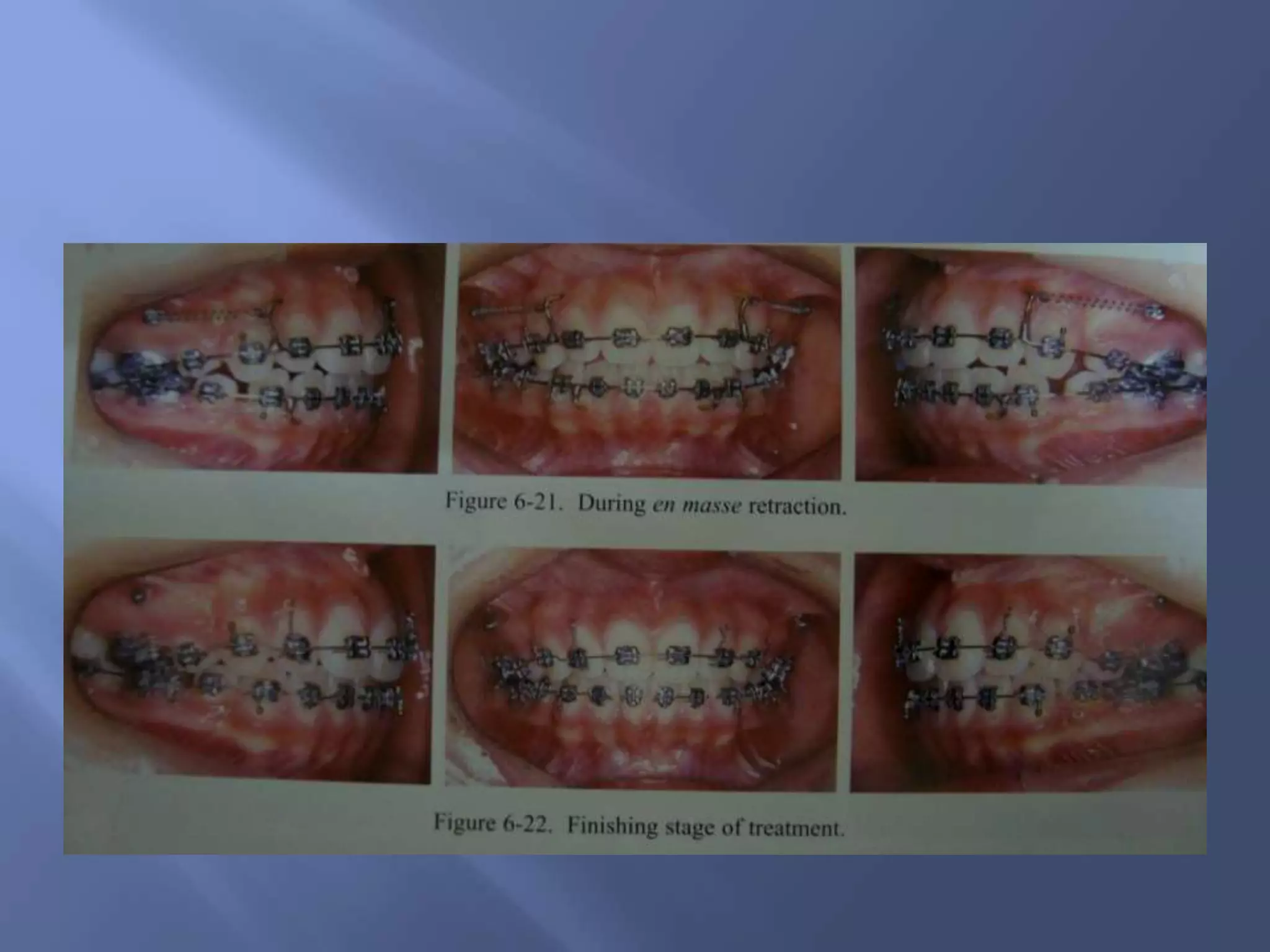 Clinical examples of microimplant anchorage | PPTX