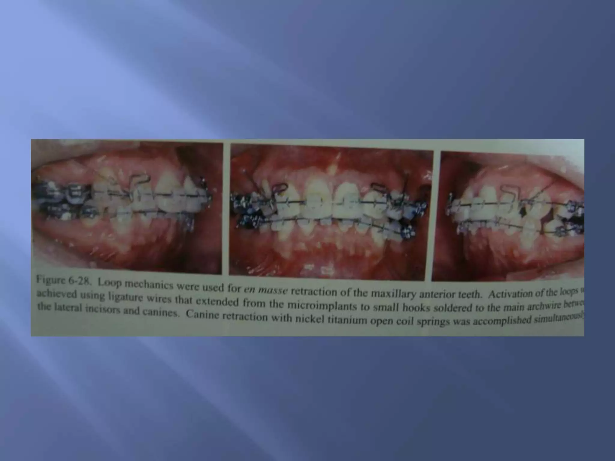 Clinical examples of microimplant anchorage | PPT