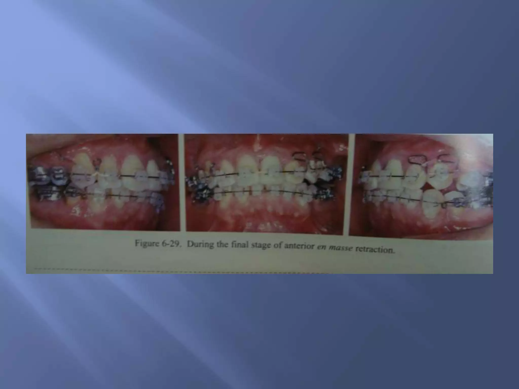 Clinical examples of microimplant anchorage | PPT